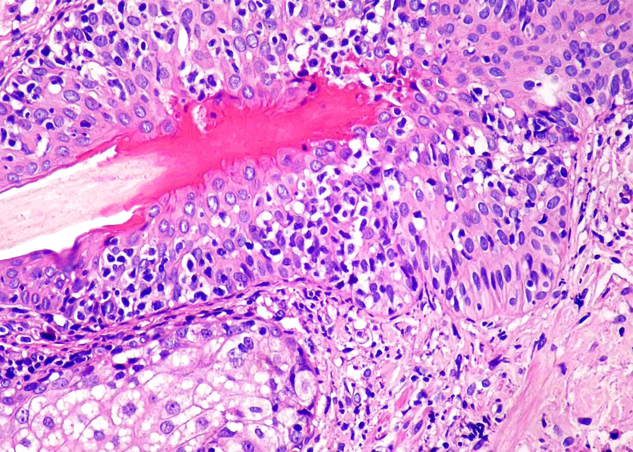 Pathology Outlines - EBV related lymphoid proliferations