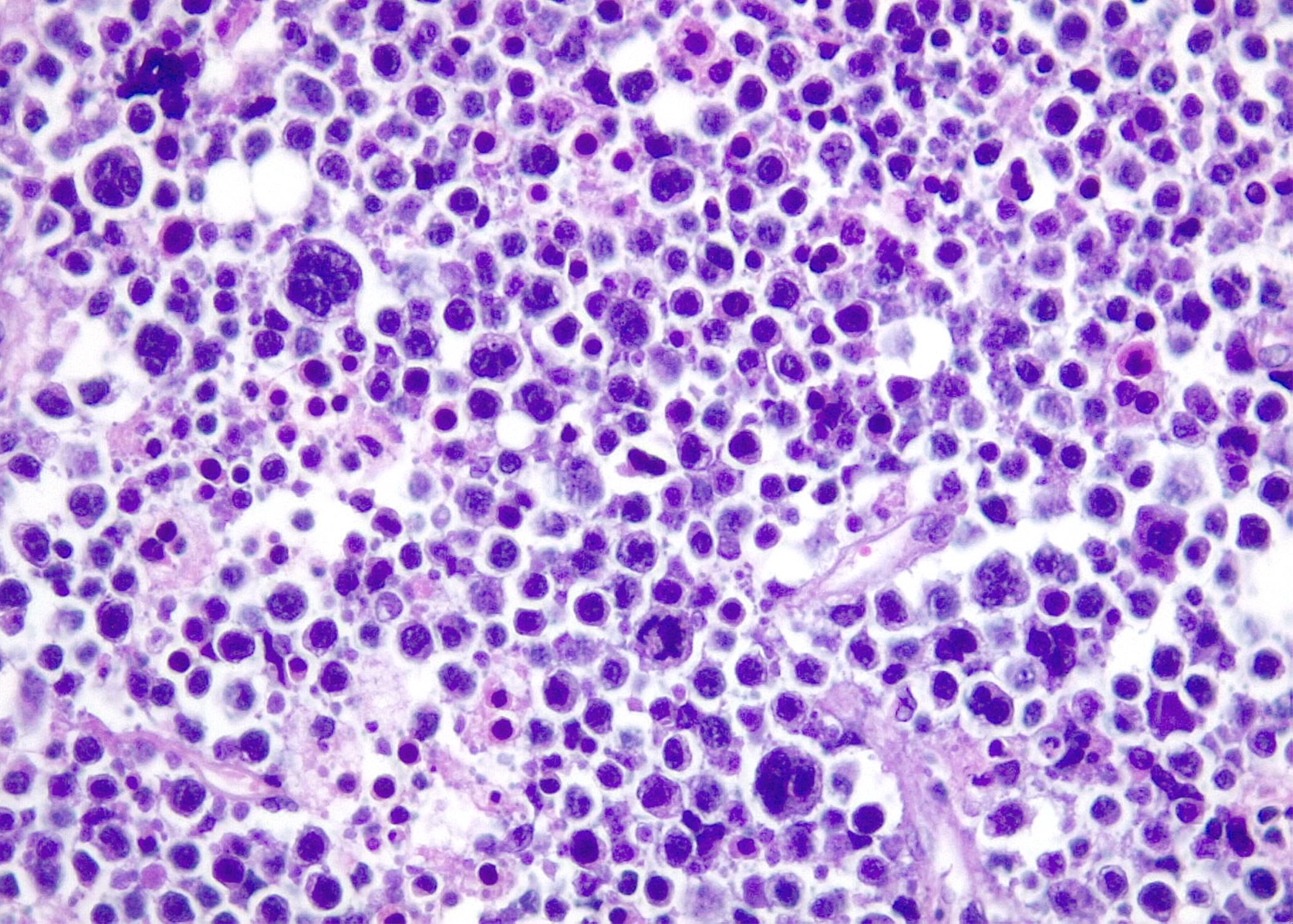 Pathology Outlines - EBV related lymphoid proliferations