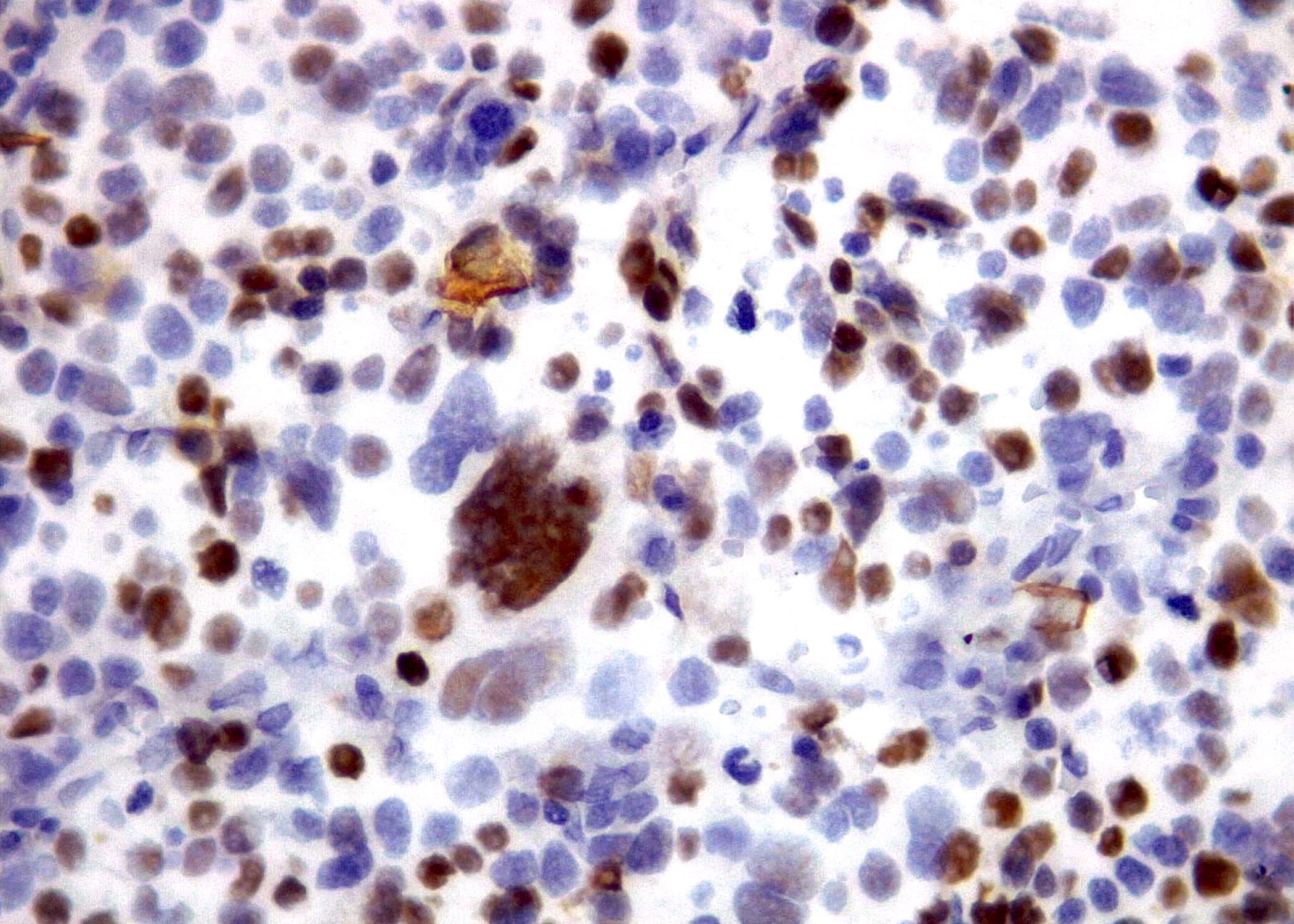 Pathology Outlines - EBV related lymphoid proliferations