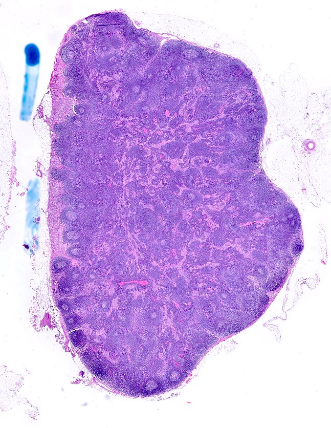 Pathology Outlines - Lymphangiomyomatosis