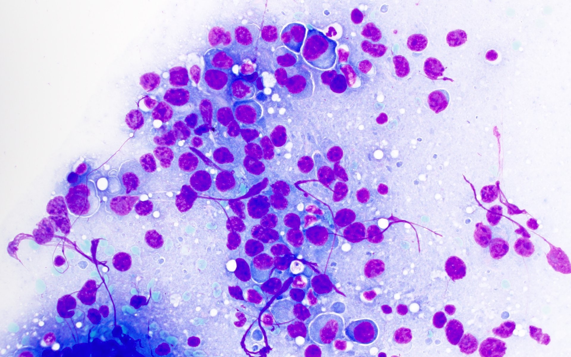 Pathology Outlines - Primary effusion lymphoma