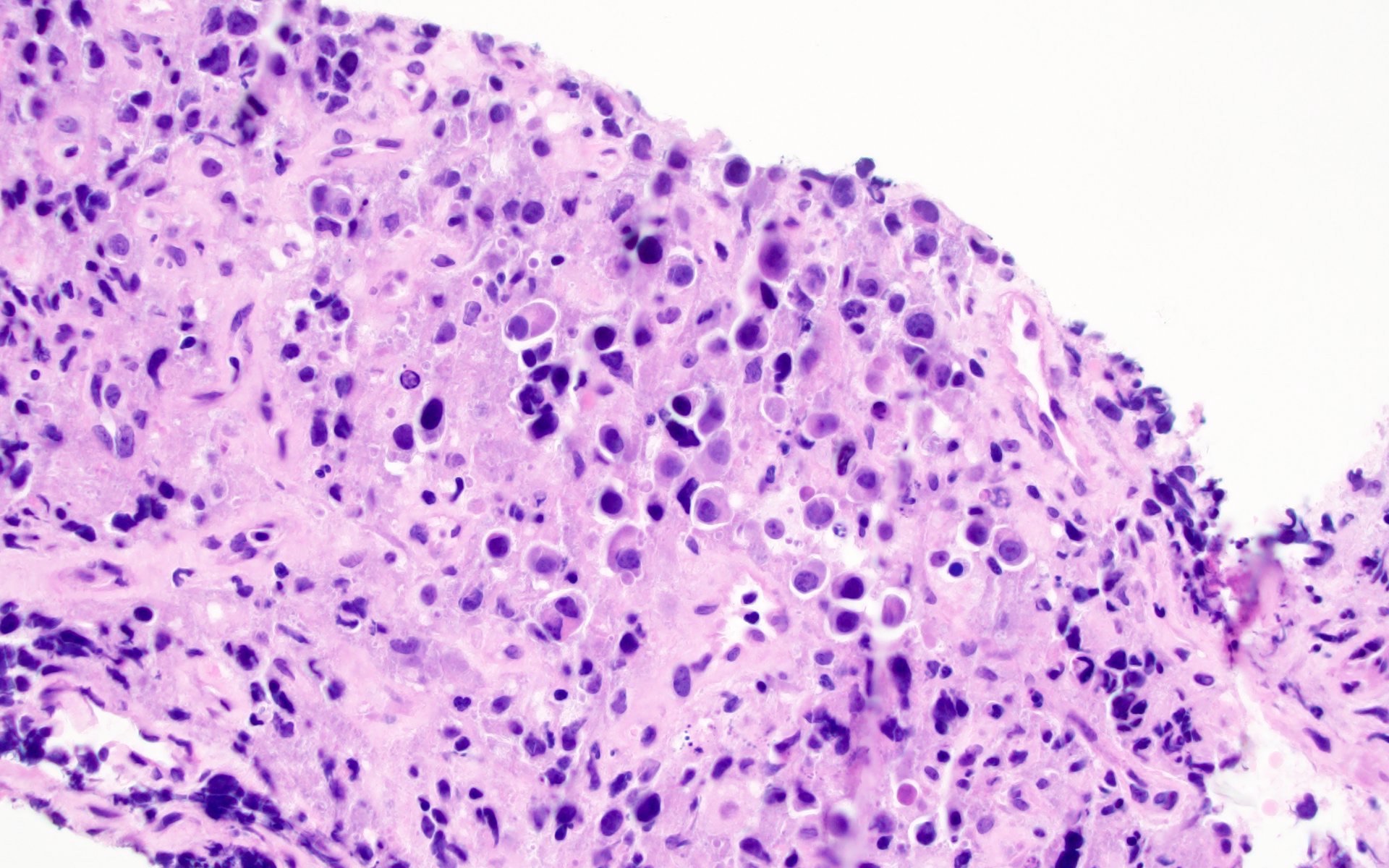Pathology Outlines - Primary effusion lymphoma