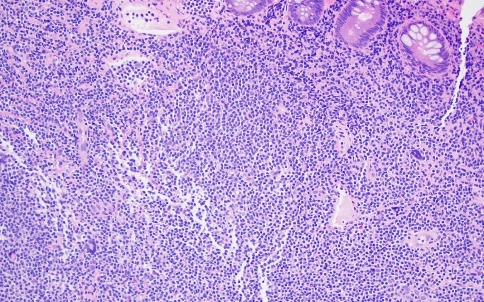 Pathology Outlines - Indolent NK cell lymphoproliferative disease of ...