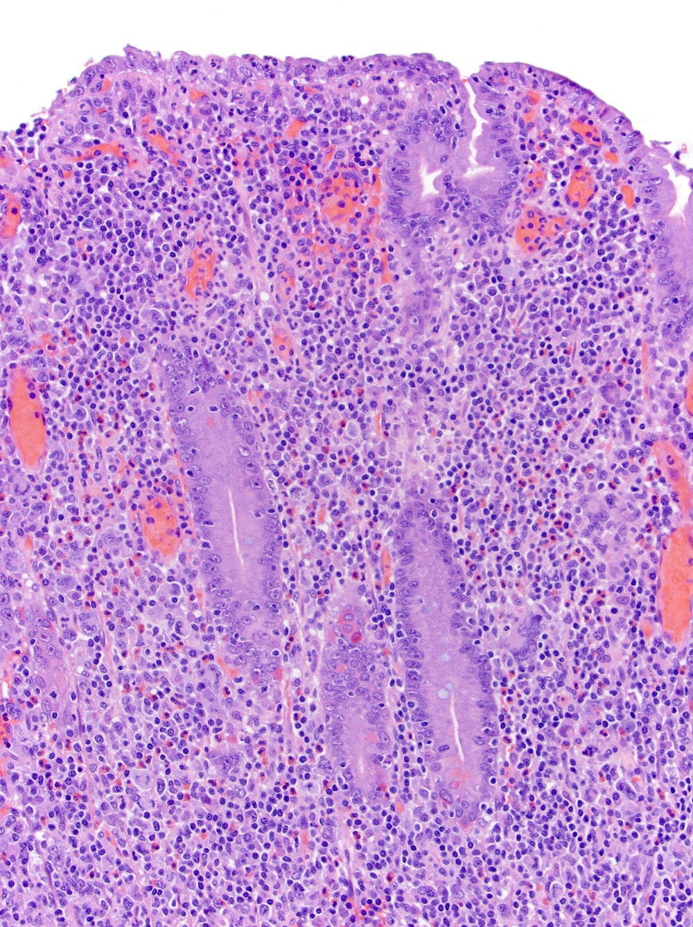 Pathology Outlines - Enteropathy associated T cell lymphoma