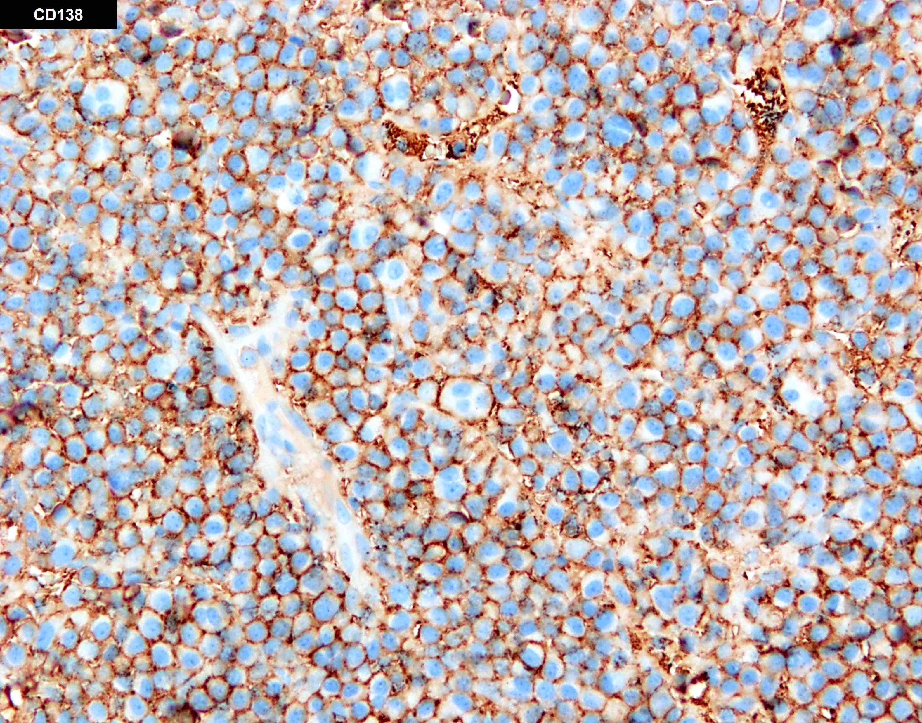 Pathology Outlines - Plasma cell leukemia