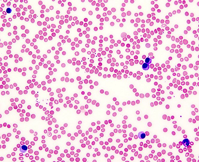 Pathology Outlines - Plasma cell leukemia