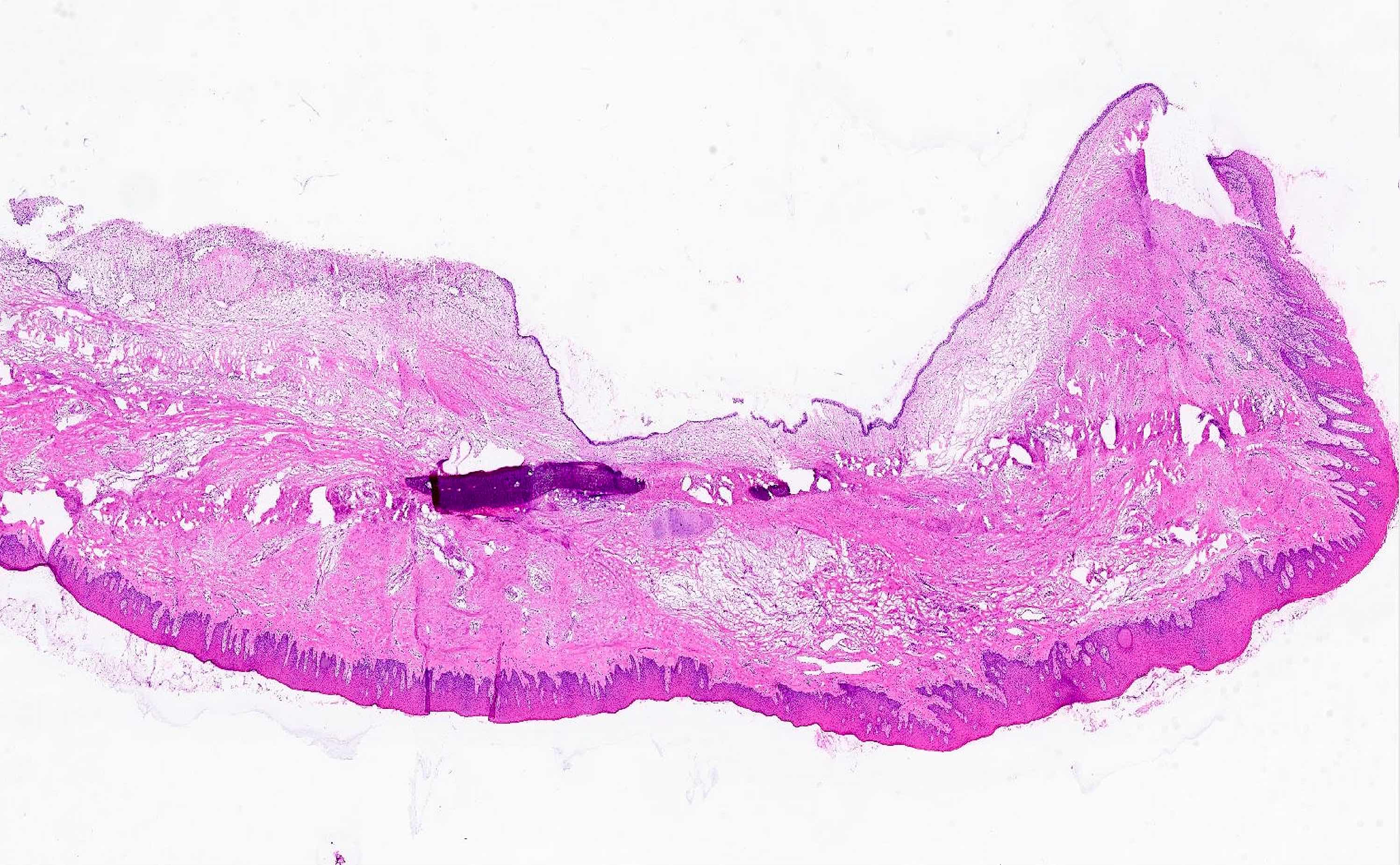 Pathology Outlines - Nasopalatine duct cyst