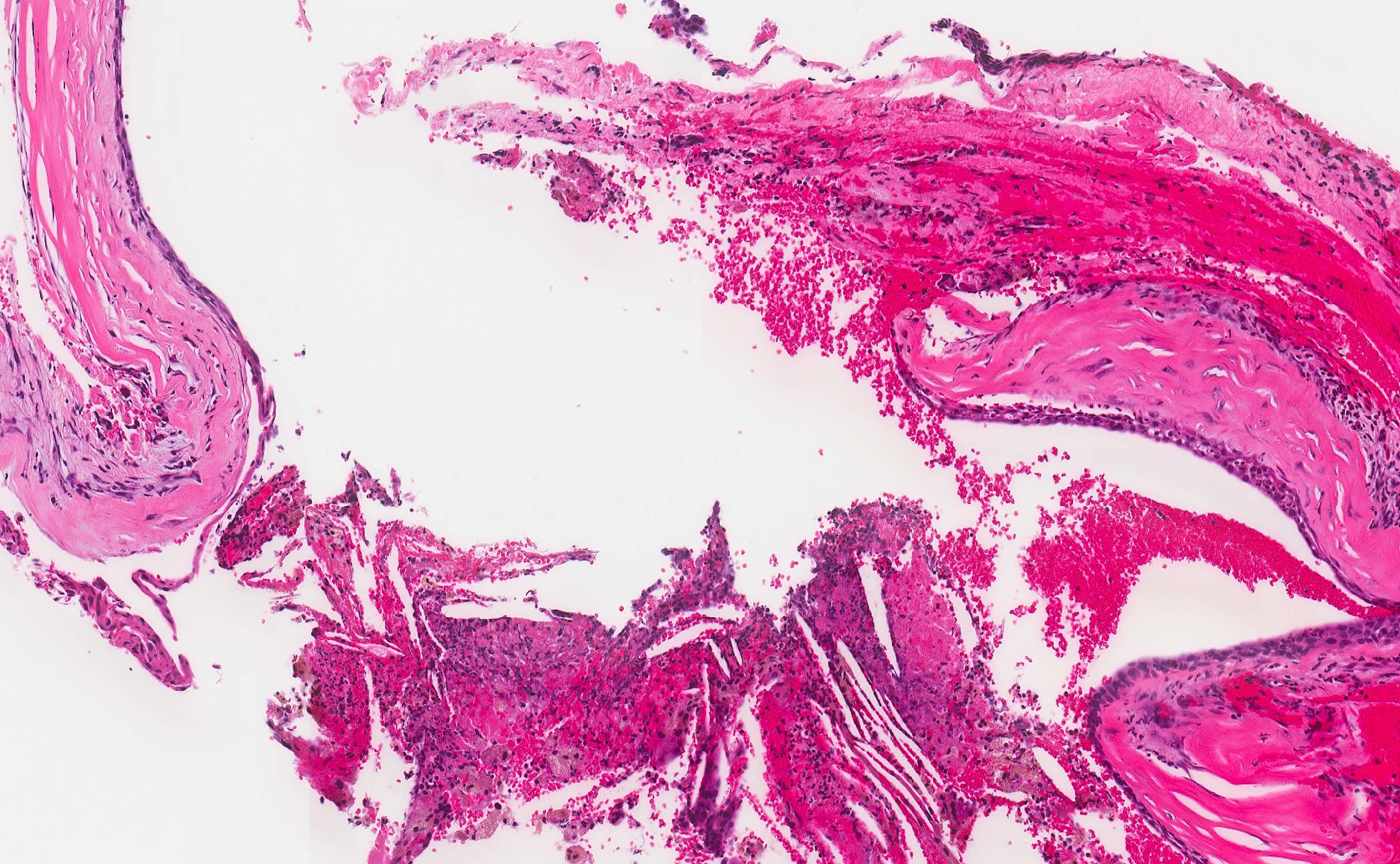 Pathology Outlines - Nasopalatine duct cyst