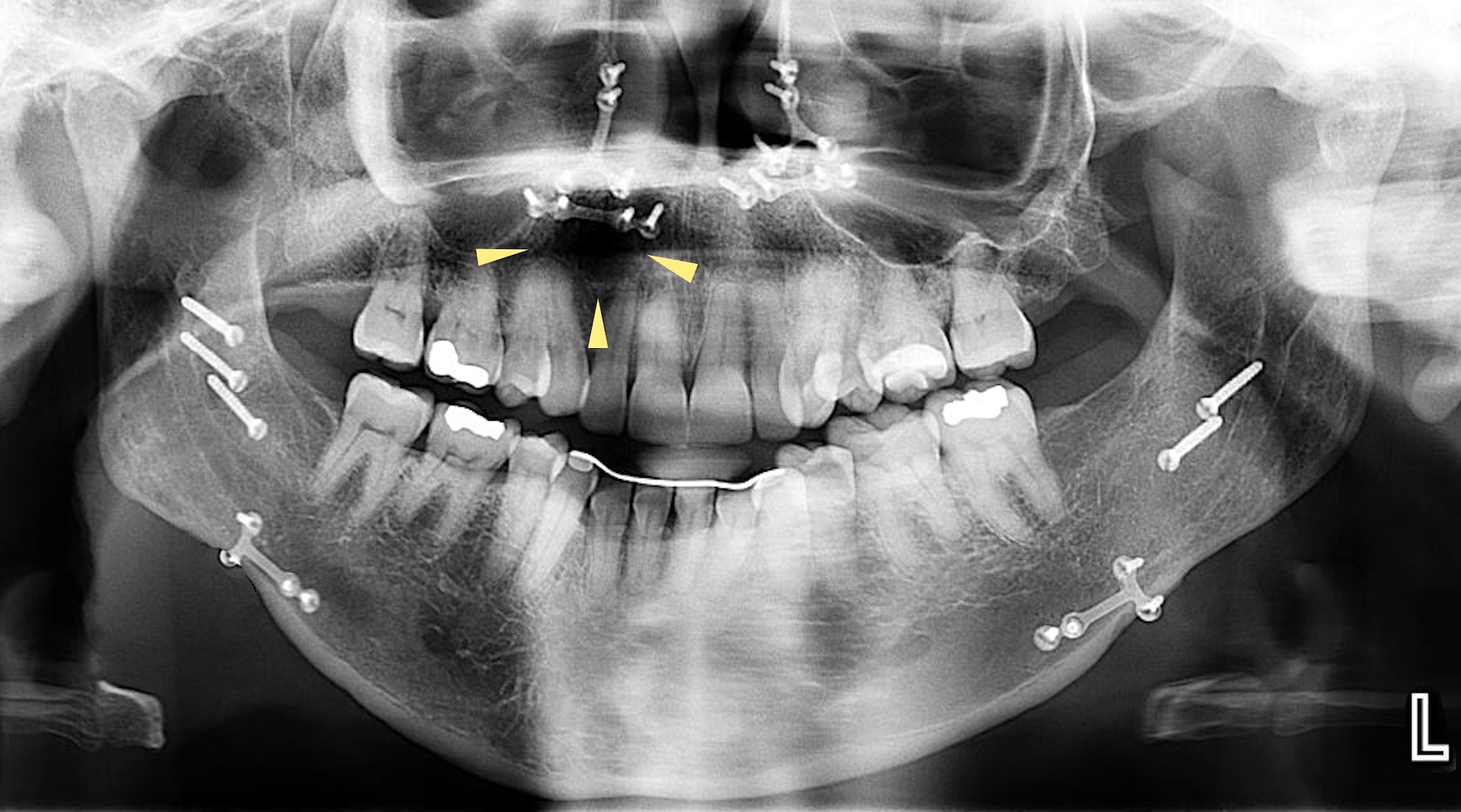 Pathology Outlines - Surgical ciliated cyst