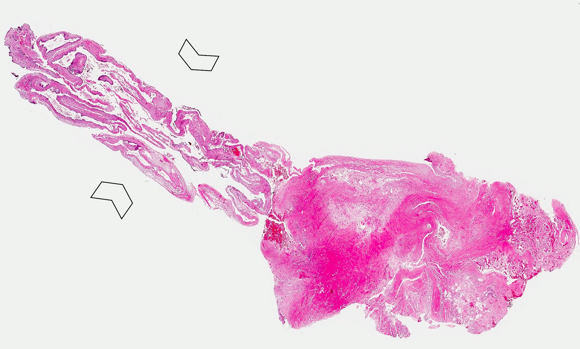 Pathology Outlines - Surgical ciliated cyst