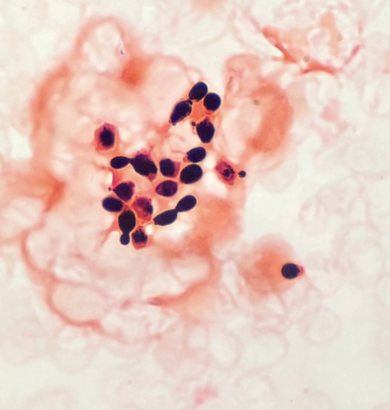 Pathology Outlines - Candida species