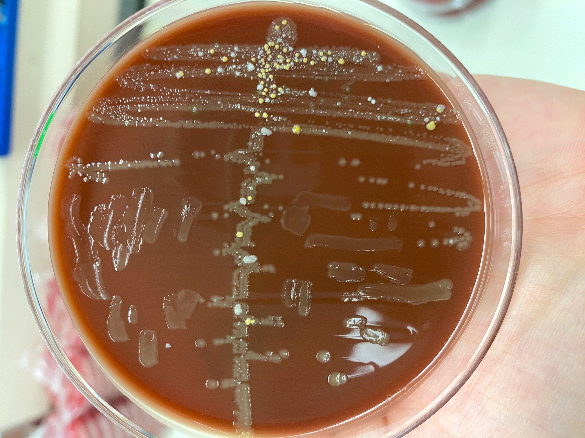Pathology Outlines - Haemophilus influenzae