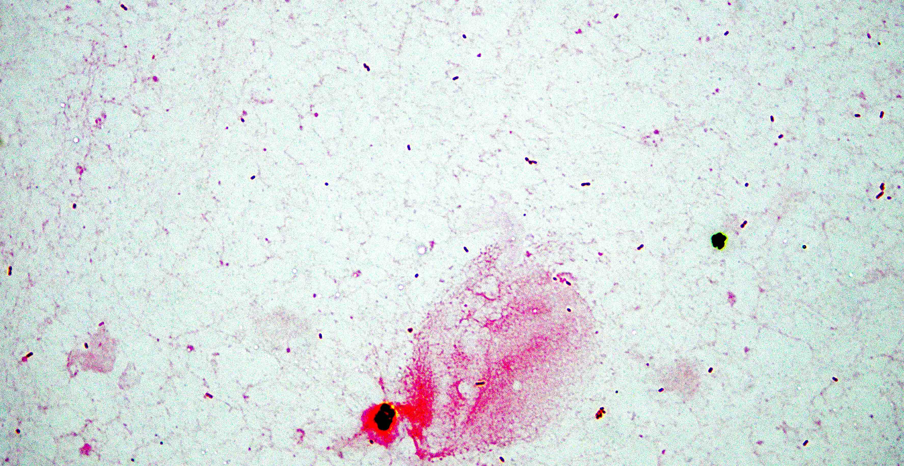 Pathology Outlines - Haemophilus influenzae