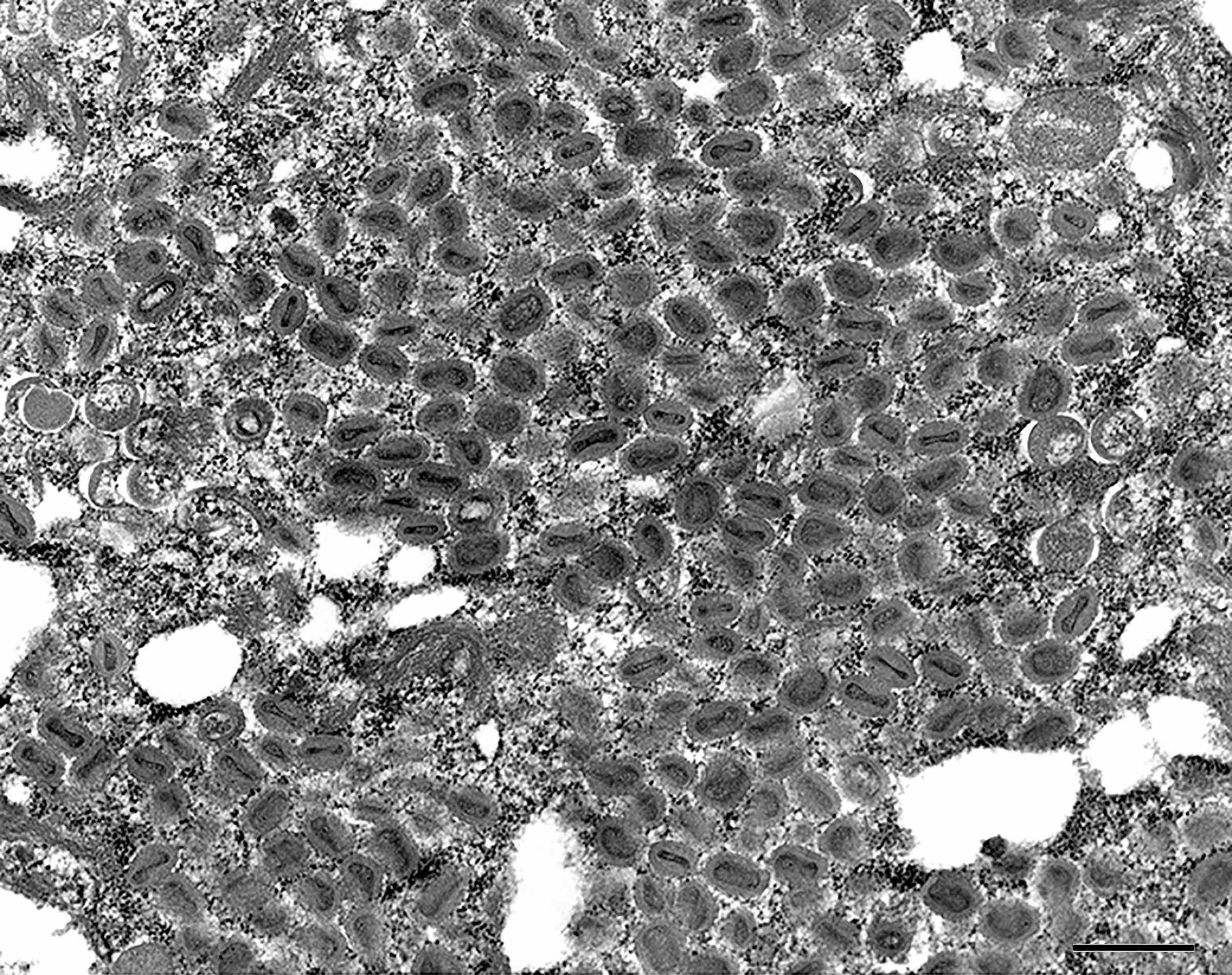 Pathology Outlines - Mpox / orthopoxvirus