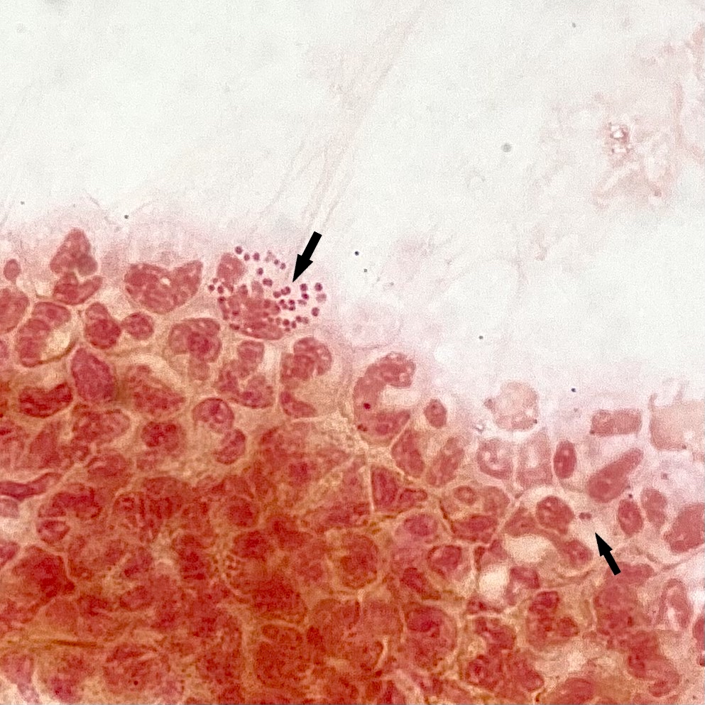Neisseria Meningitidis Gram Stain
