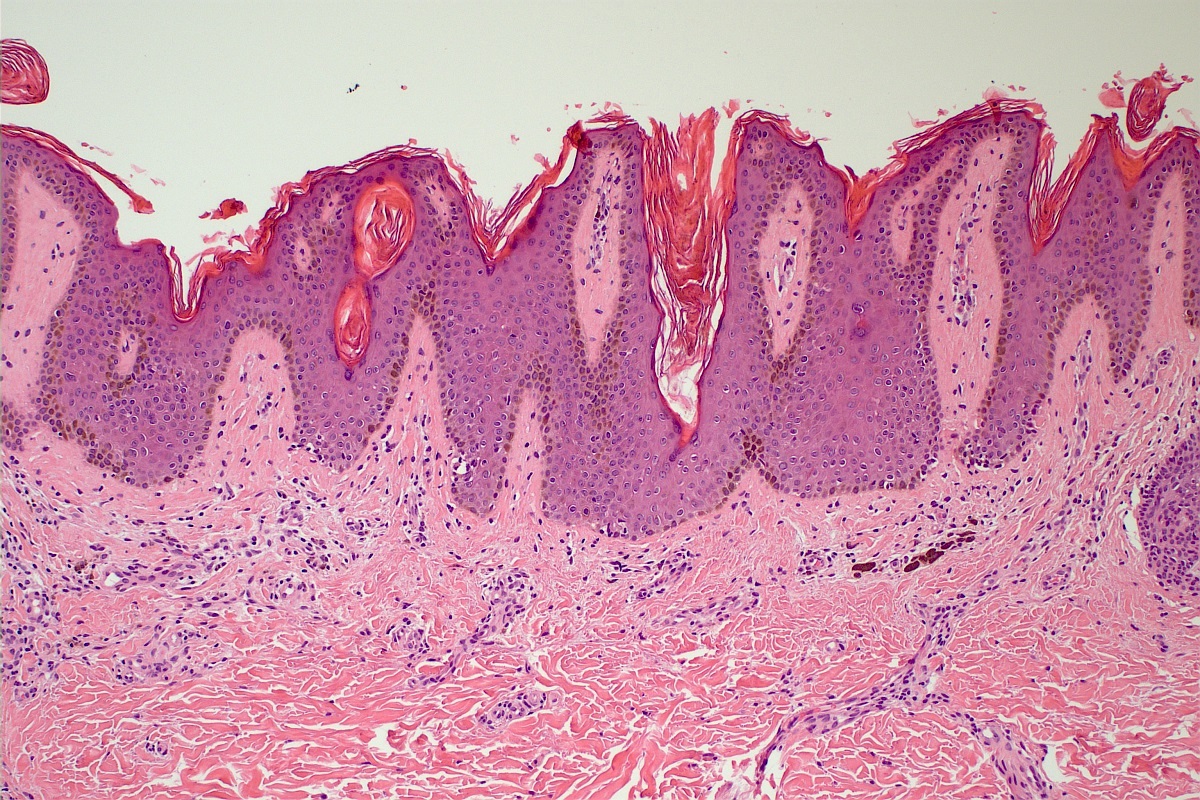 Epidermal Nevus Histology Pathology Outlines Nevus Sebaceus Of