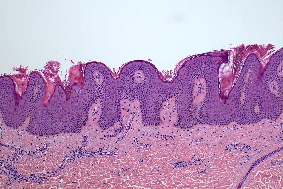 Epidermal Nevus