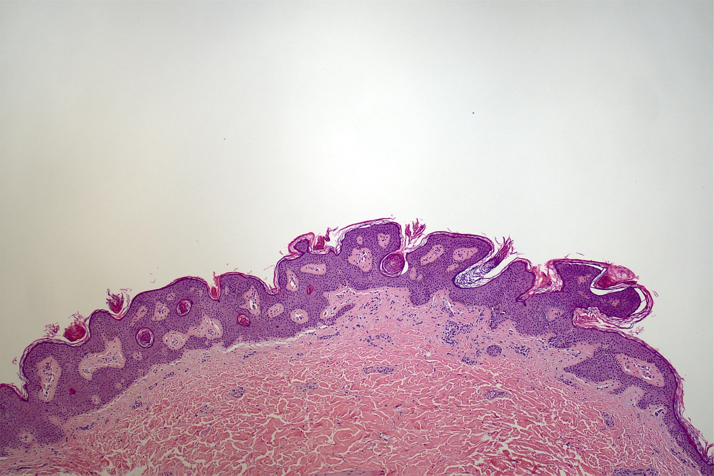 Epidermal Nevus Histology Pathology Outlines Nevus Sebaceus Of