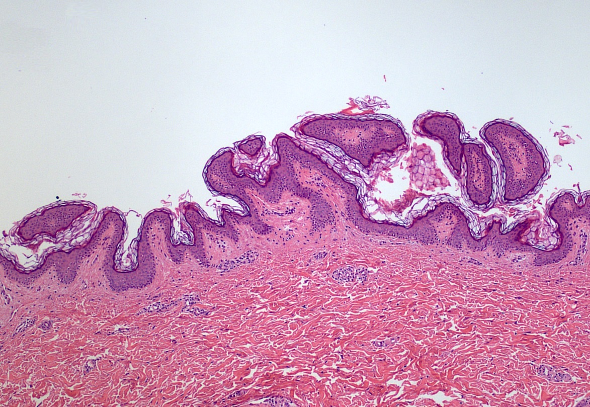 Pathology Outlines - Epidermal nevus
