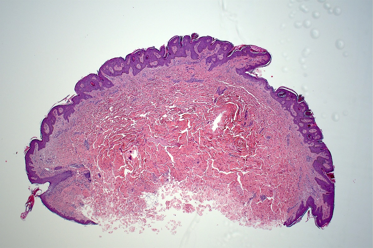 Epidermal Nevus Histology Pathology Outlines Nevus Sebaceus Of