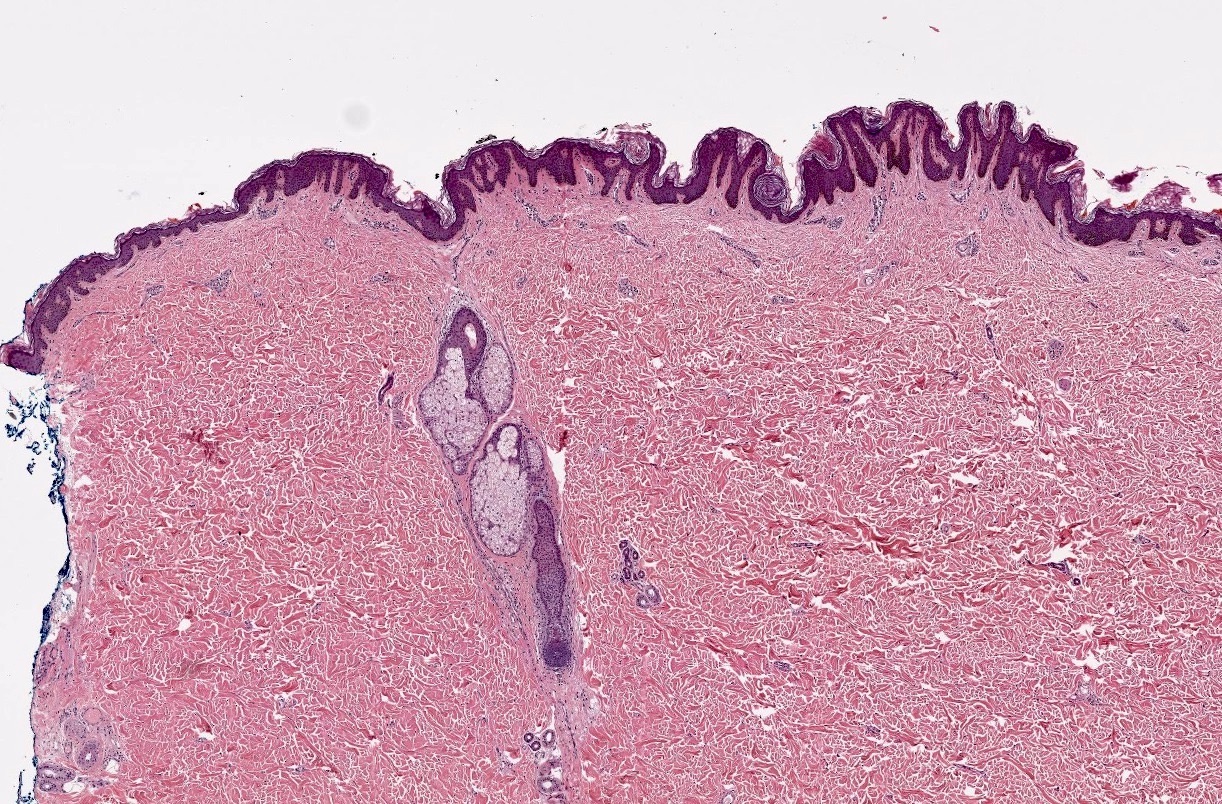 Epidermal Nevus Histology Pathology Outlines Nevus Sebaceus Of