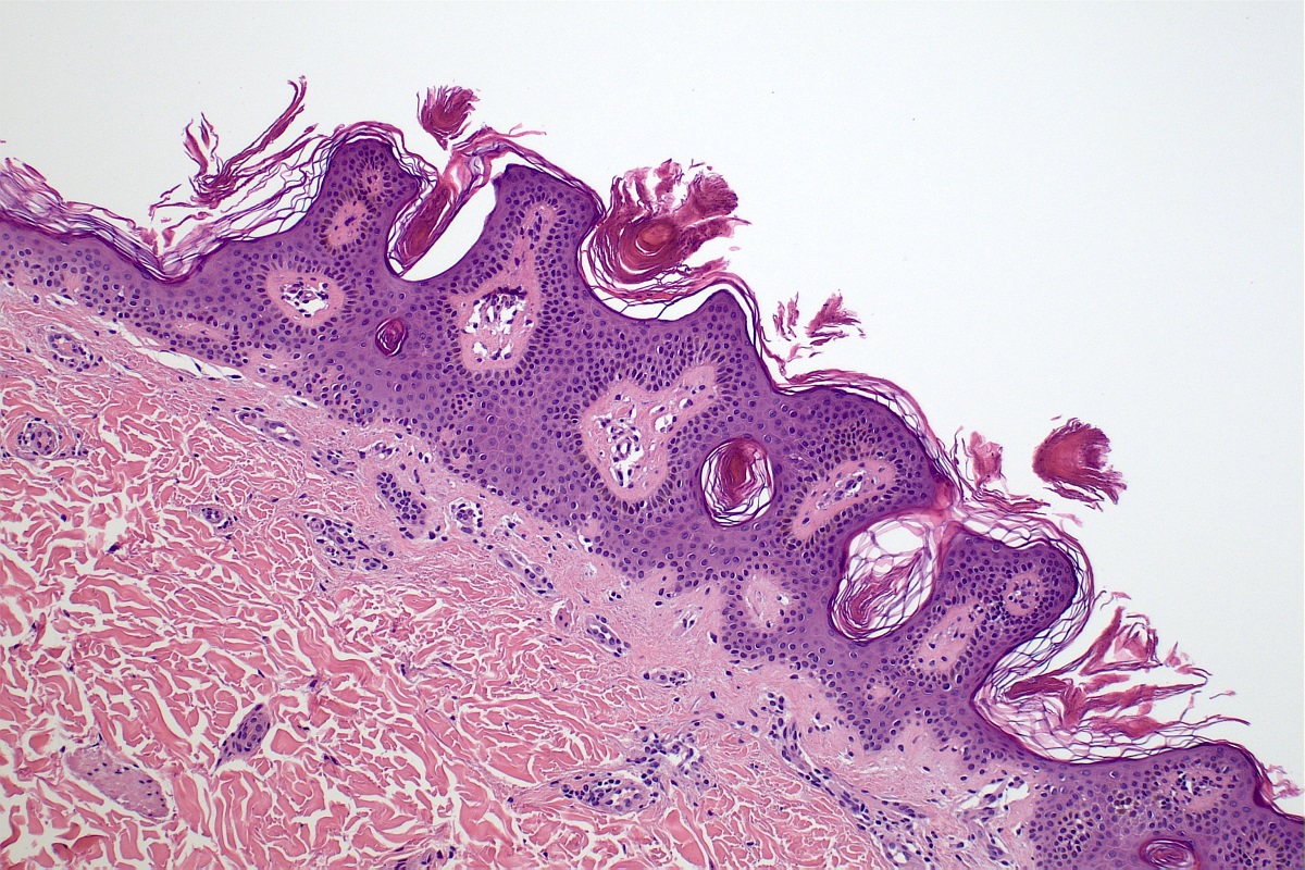 Pathology Outlines - Epidermal nevus