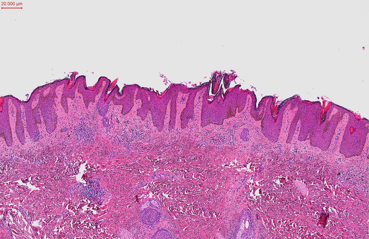 Verruca Plantaris Pathology Outlines