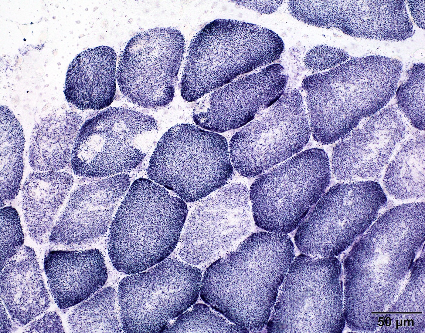 Pathology Outlines - Multiminicore myopathy