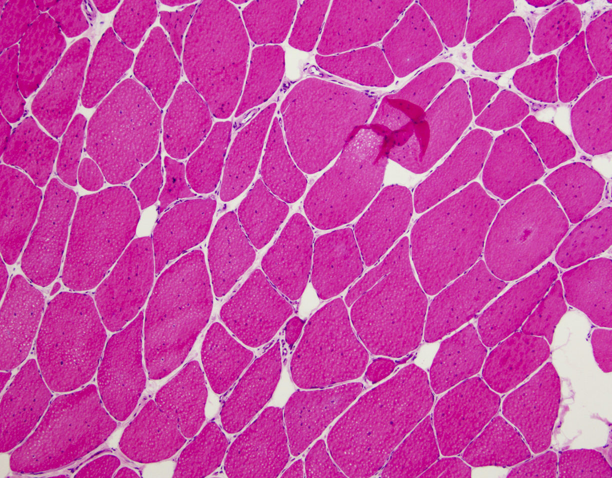 Pathology Outlines - Myotonic dystrophy