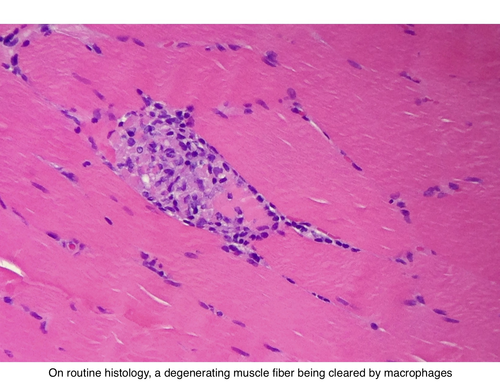 Pathology Outlines - Polymyositis