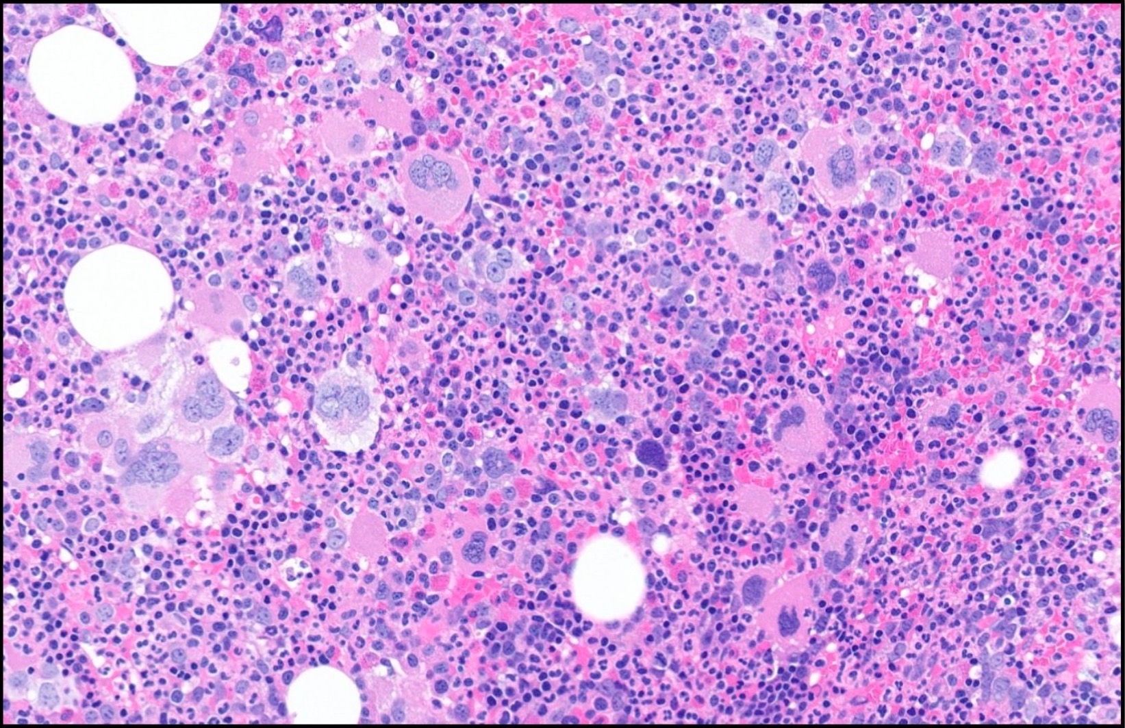 Myelofibrosis Teardrop Cells