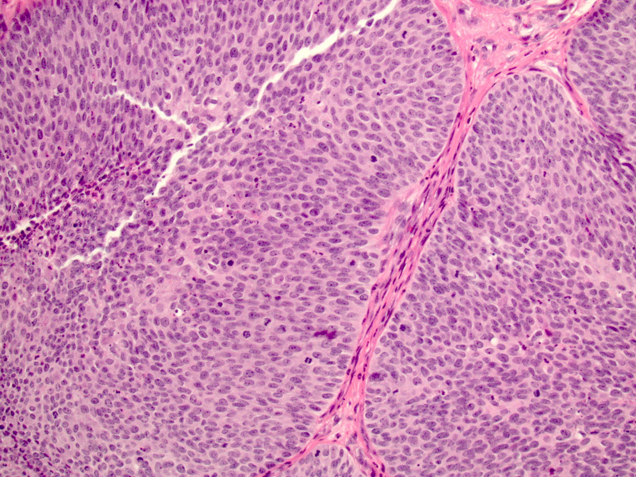 Pathology Outlines - Squamous cell carcinoma