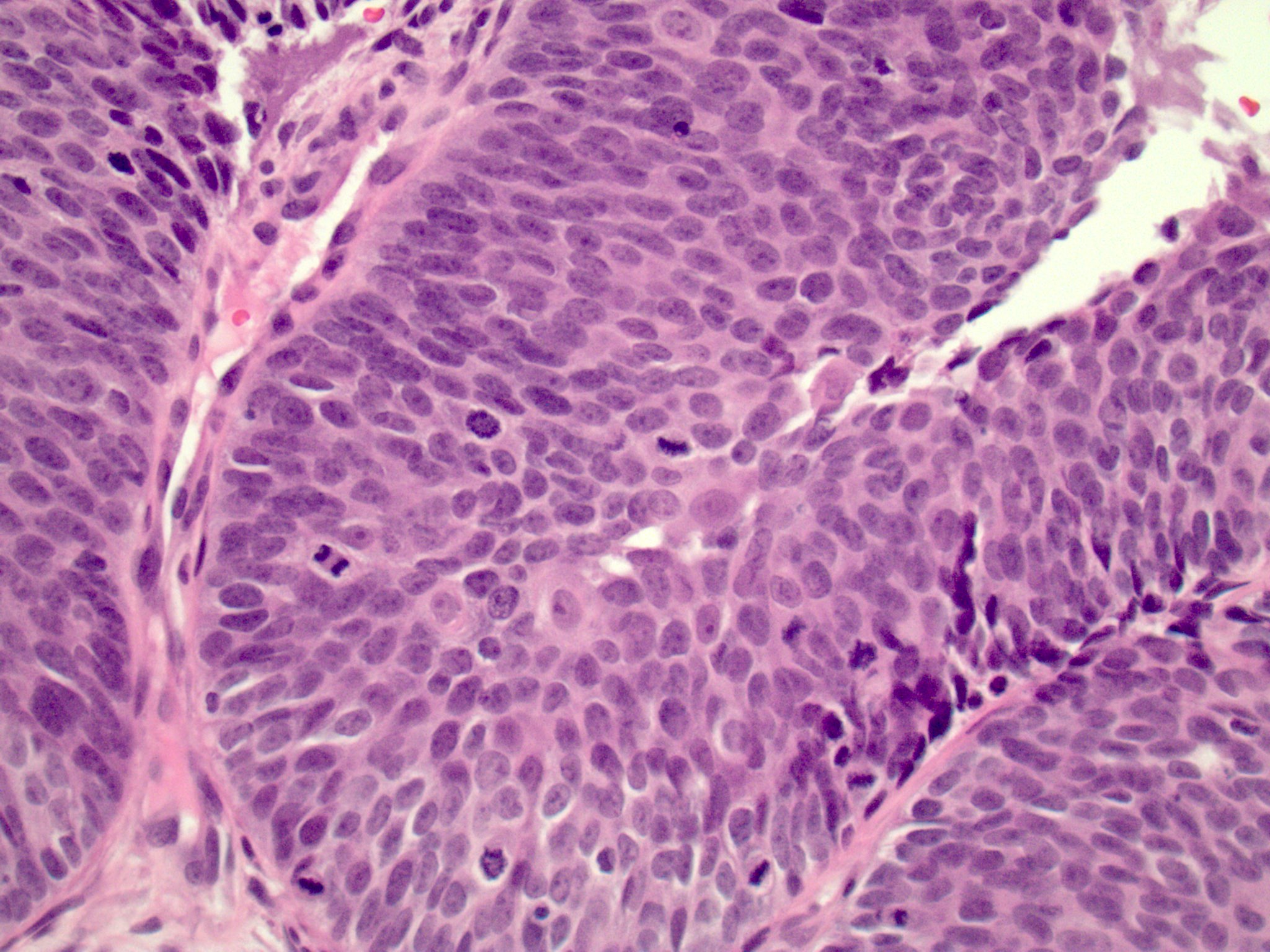 Pathology Outlines Nasopharyngeal Carcinoma