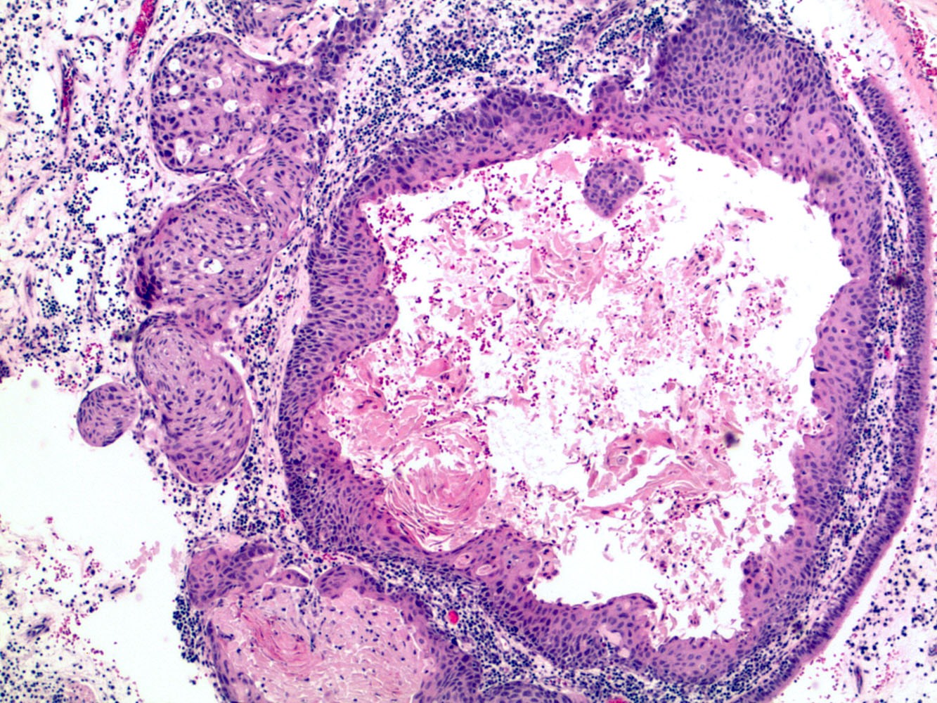 Pathology Outlines Nasopharyngeal Carcinoma