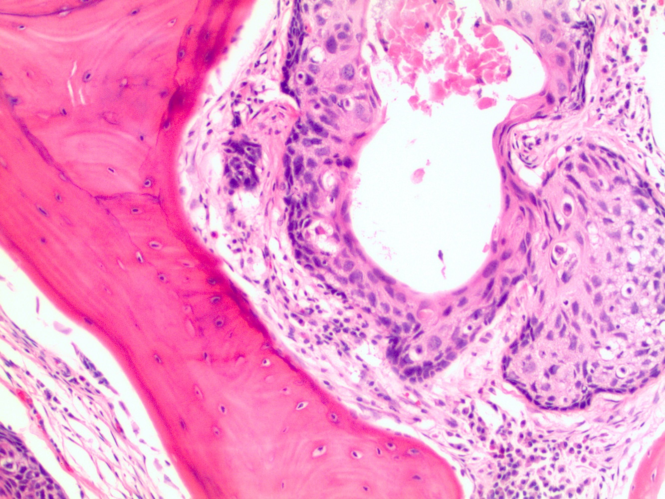 Pathology Outlines Nasopharyngeal Carcinoma