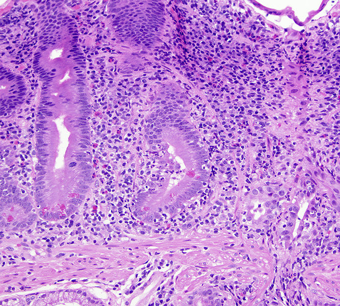 Pathology Outlines - Olmesartan enteropathy