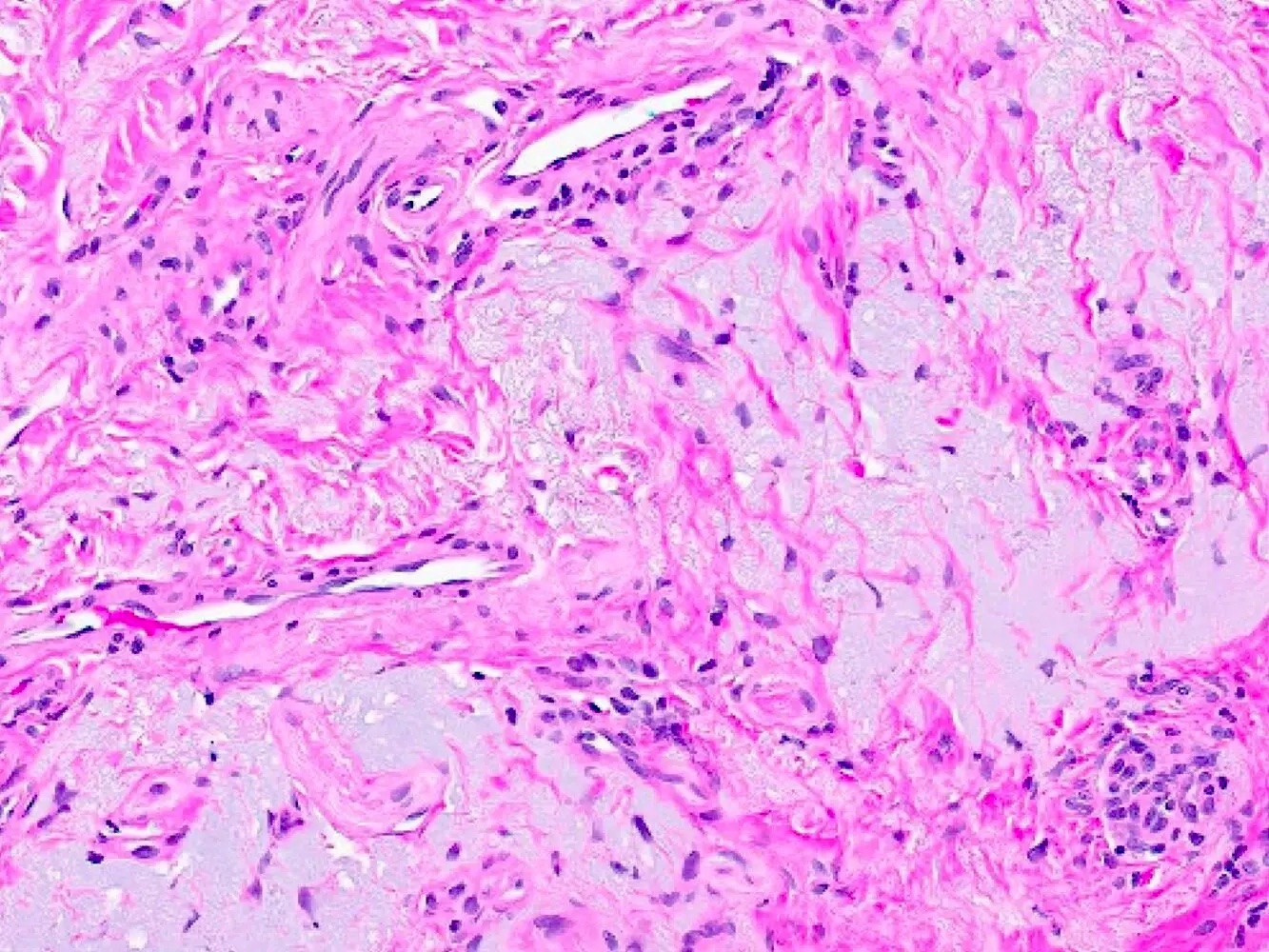 Pathology Outlines - Actinic cheilitis