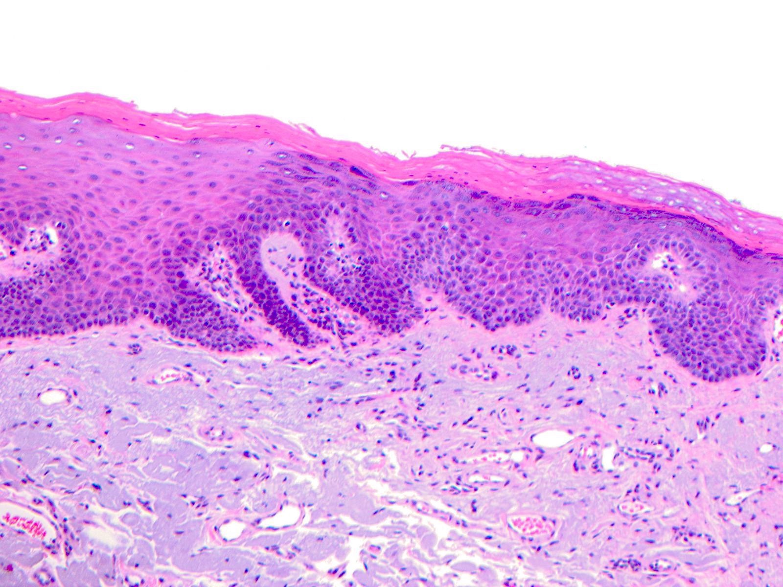 Pathology Outlines - Actinic cheilitis