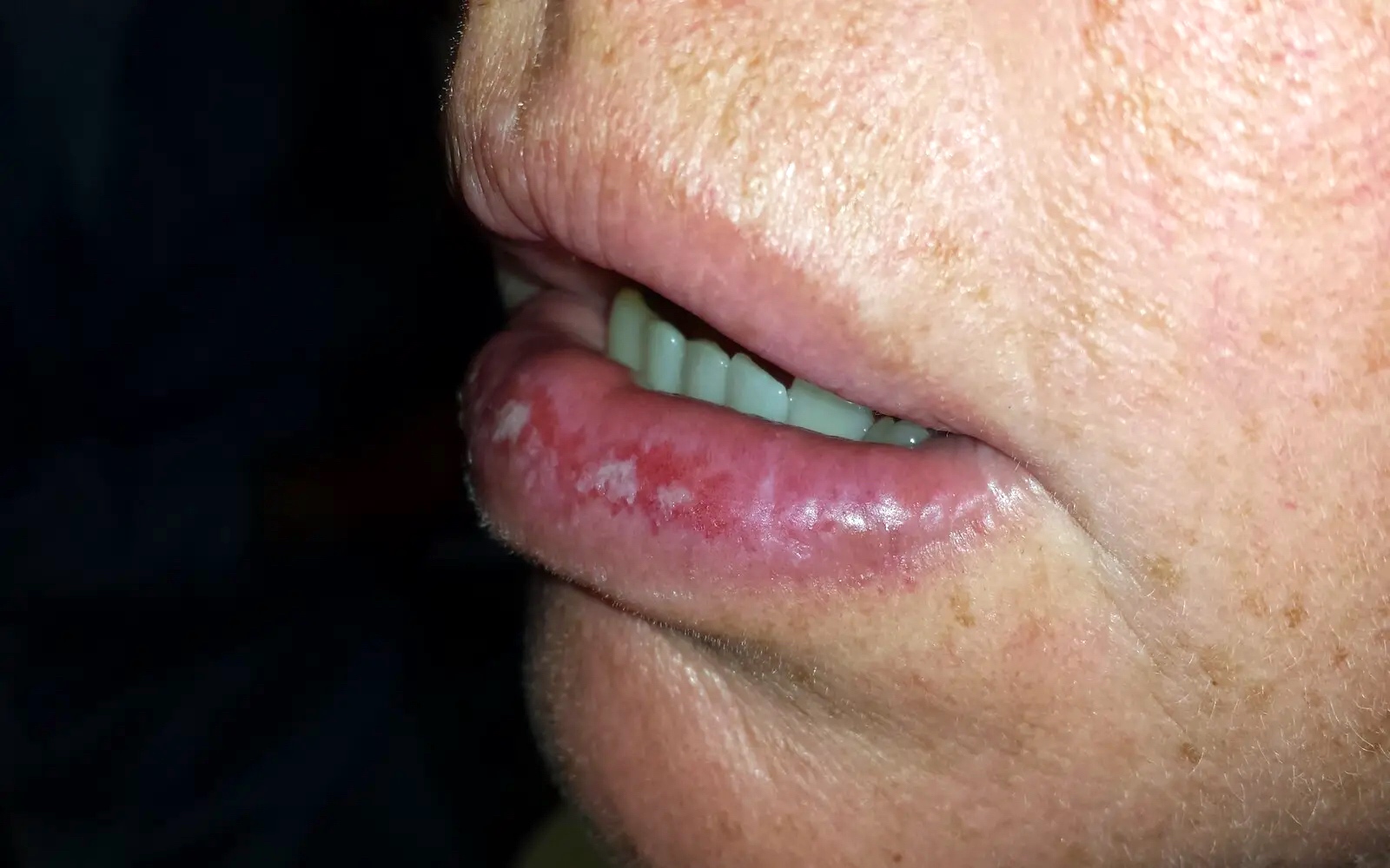 Actinic Keratosis Lip