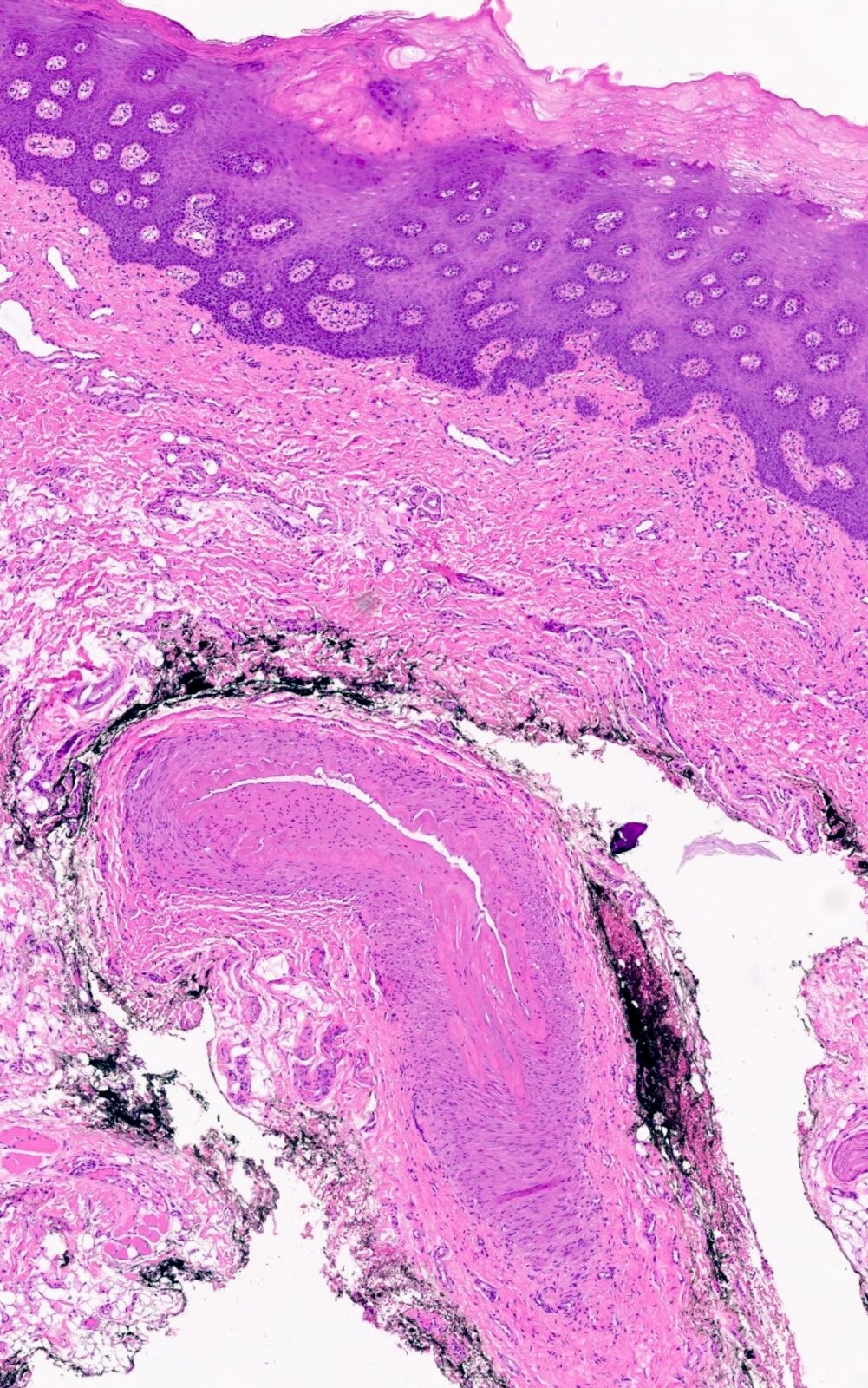 Pathology Outlines - Caliber persistent artery