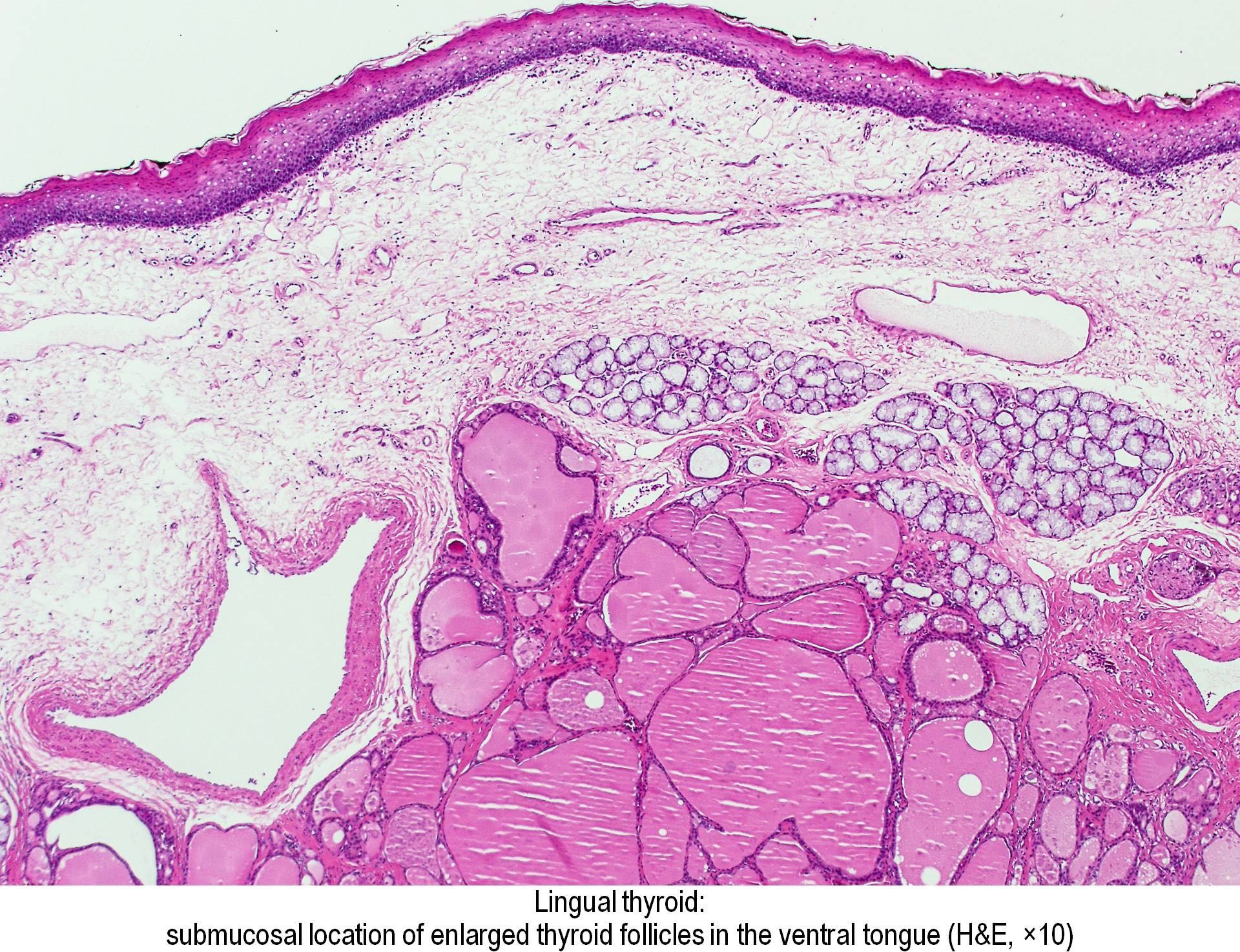 Pathology Outlines - Lingual thyroid