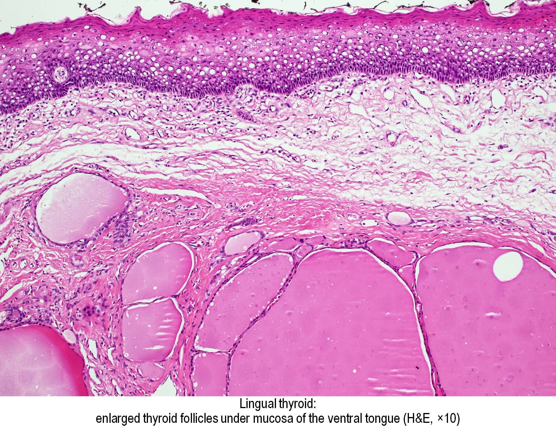 Pathology Outlines - Lingual thyroid