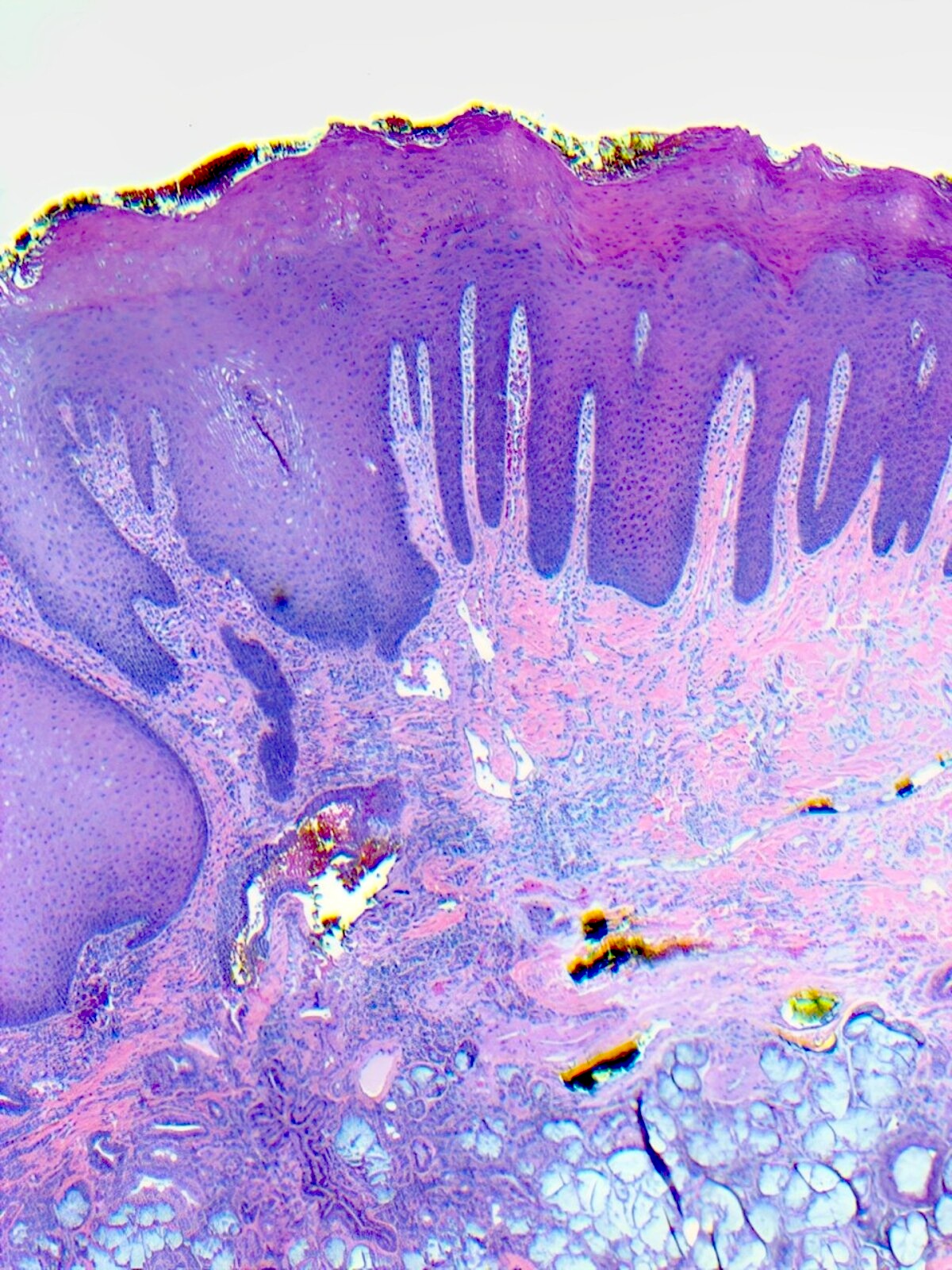 Nicotine Stomatitis In Mandibular Mucosa Stomatitis: What Is It,