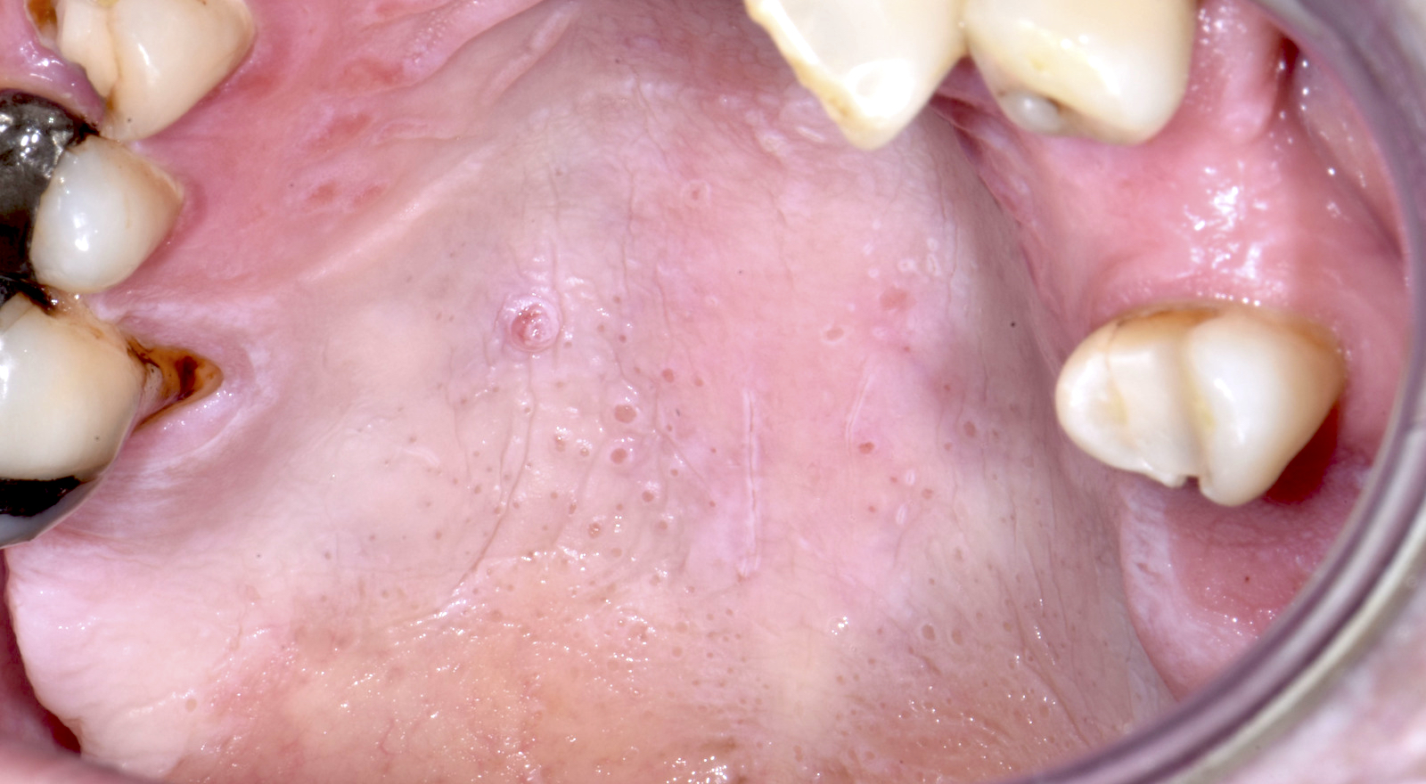 Nicotine Stomatitis Images