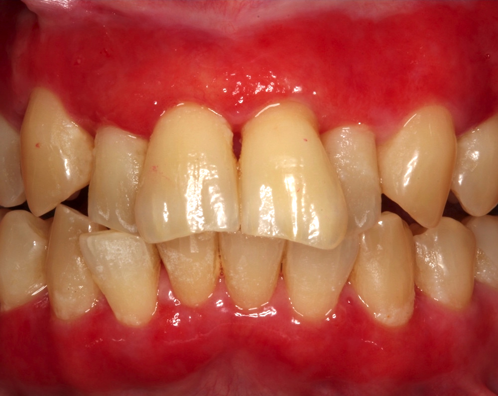 Pathology Outlines - Pemphigoid