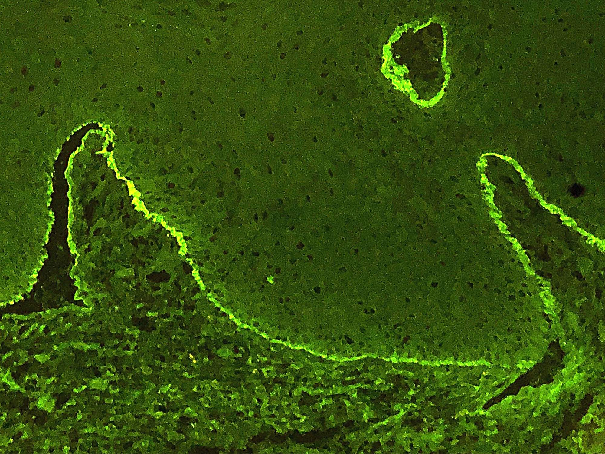 Pathology Outlines - Pemphigoid