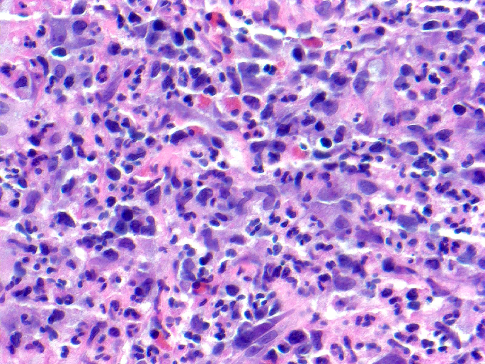 Pathology Outlines - Pyostomatitis vegetans