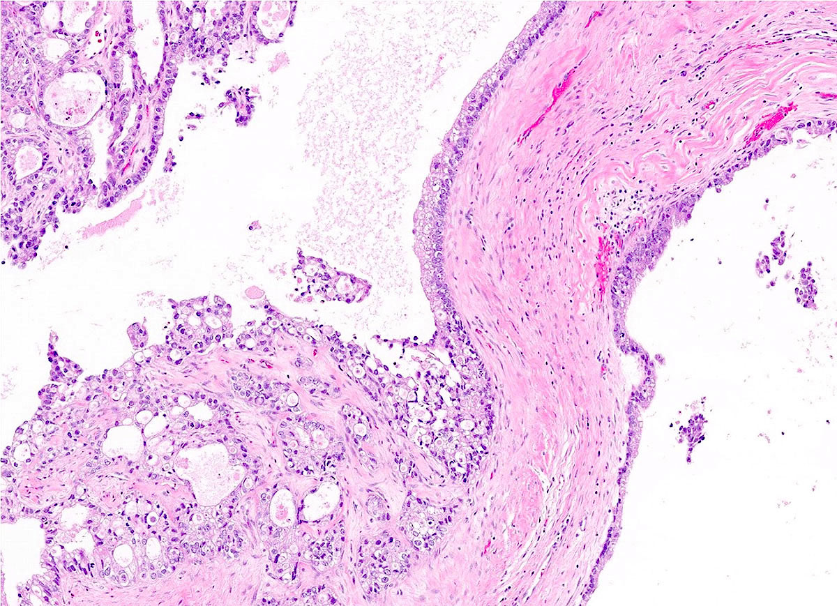 Pathology Outlines - Mixed carcinoma