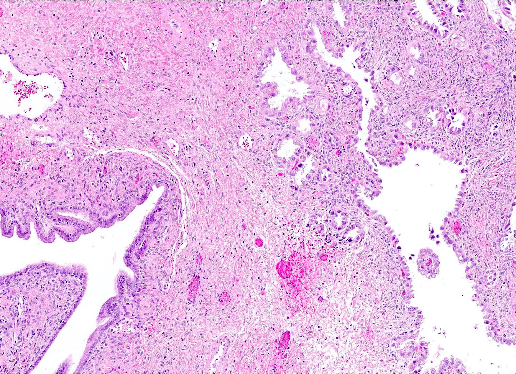 Pathology Outlines - Mixed carcinoma