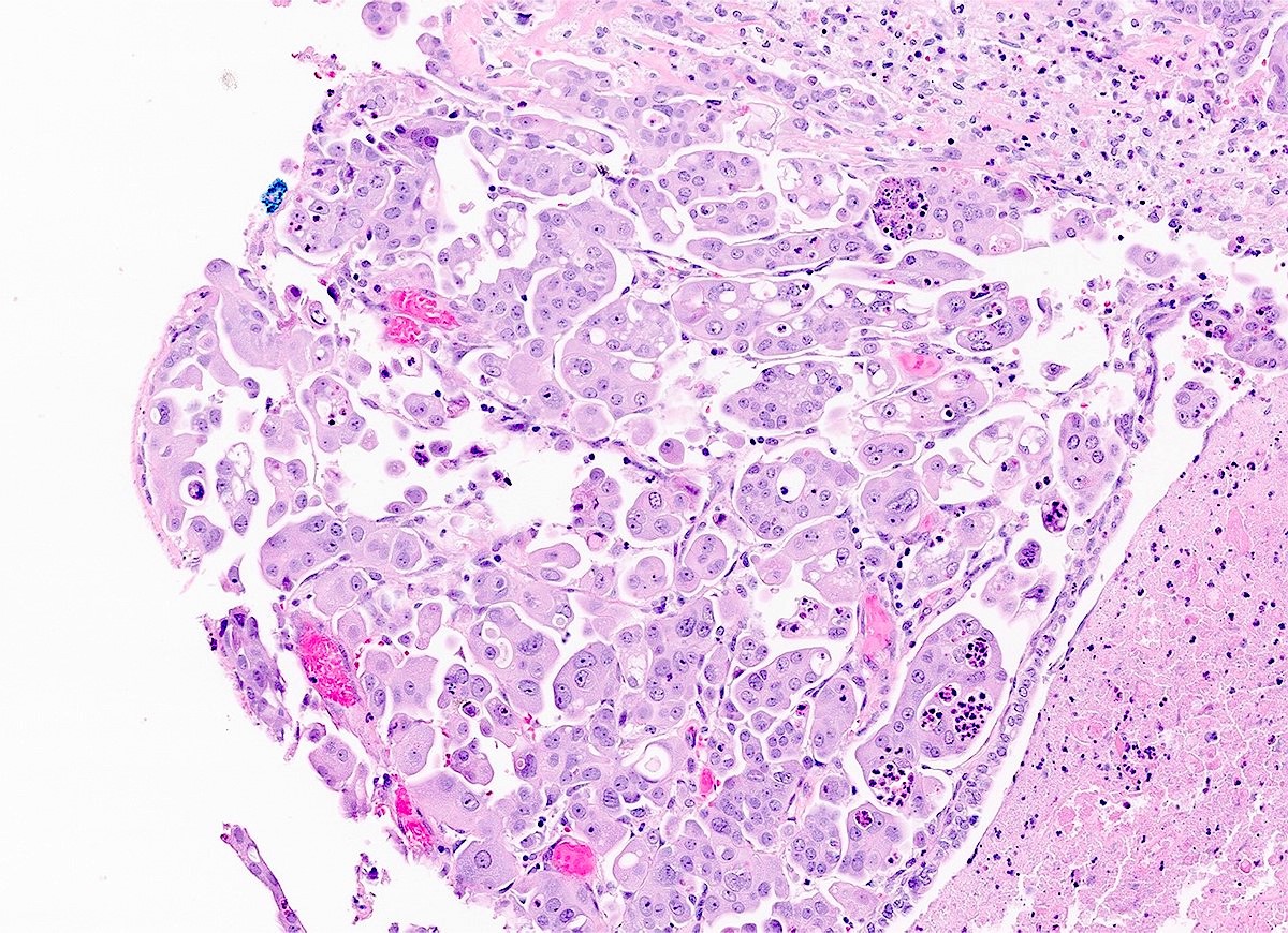 Pathology Outlines - Mixed carcinoma